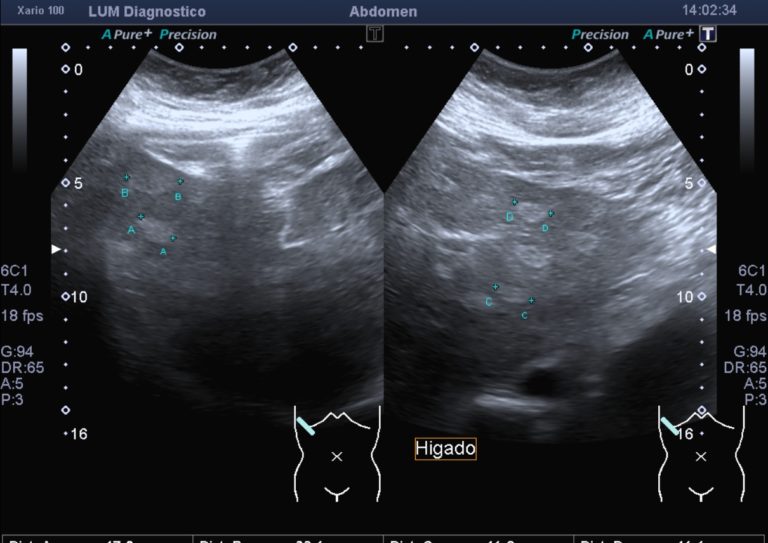 Esteatosis hepática focal multinodular