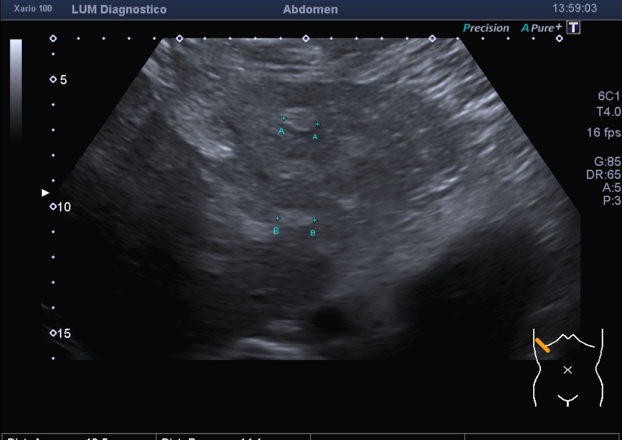 Esteatosis hepática focal multinodular