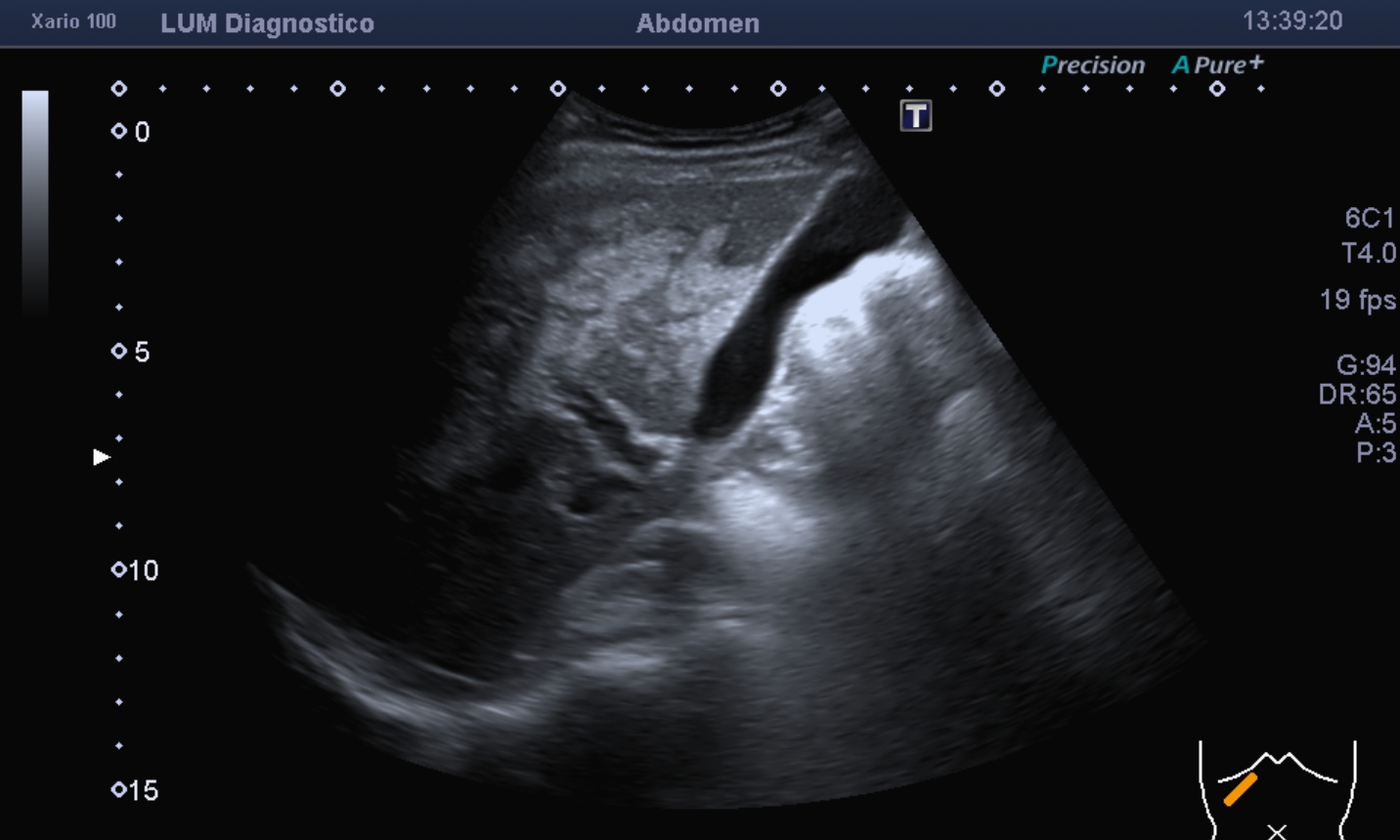 Esteatosis hepática focal multinodular
