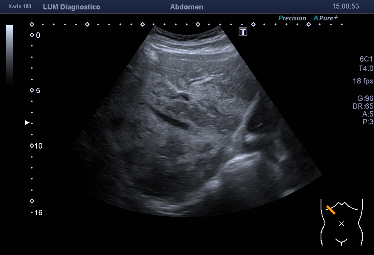 Esteatosis hepática focal multinodular
